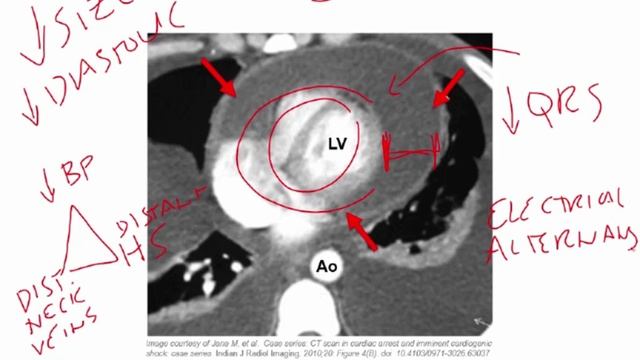 USMLE RX - 2.Кардиология - 3.Патология - 8.Тампонада сердца