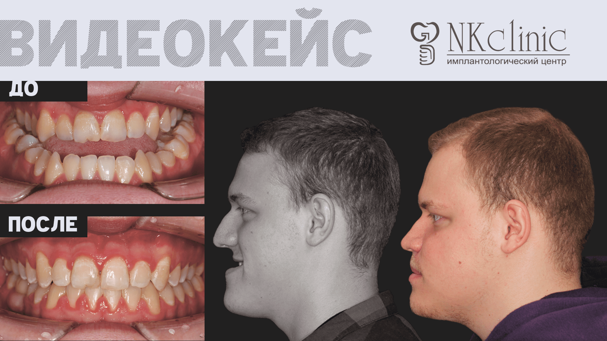 Исправление аномалии челюстно-черепных соотношений