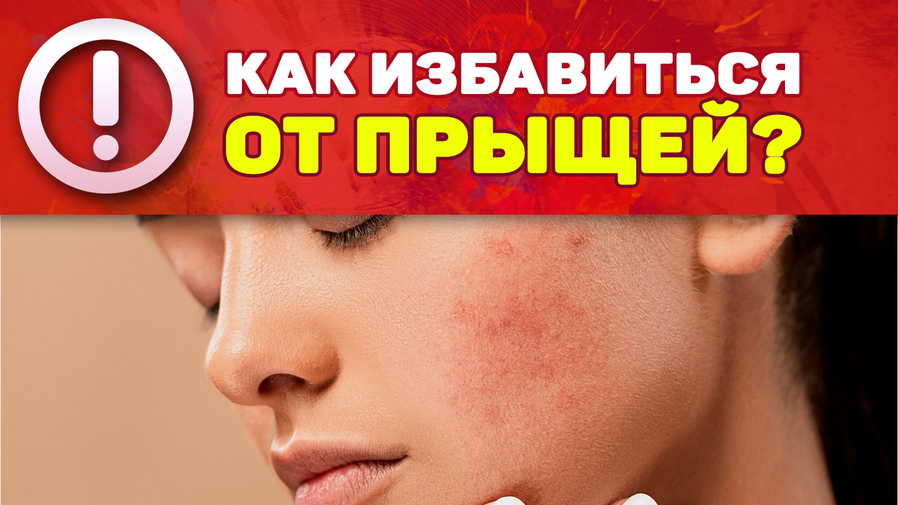 Как избавиться от прыщей на лице