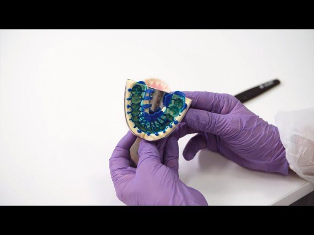 Двухэтапная техника получения оттиска.  Коррекция оттиска с помощью С силикона Very Light Flow