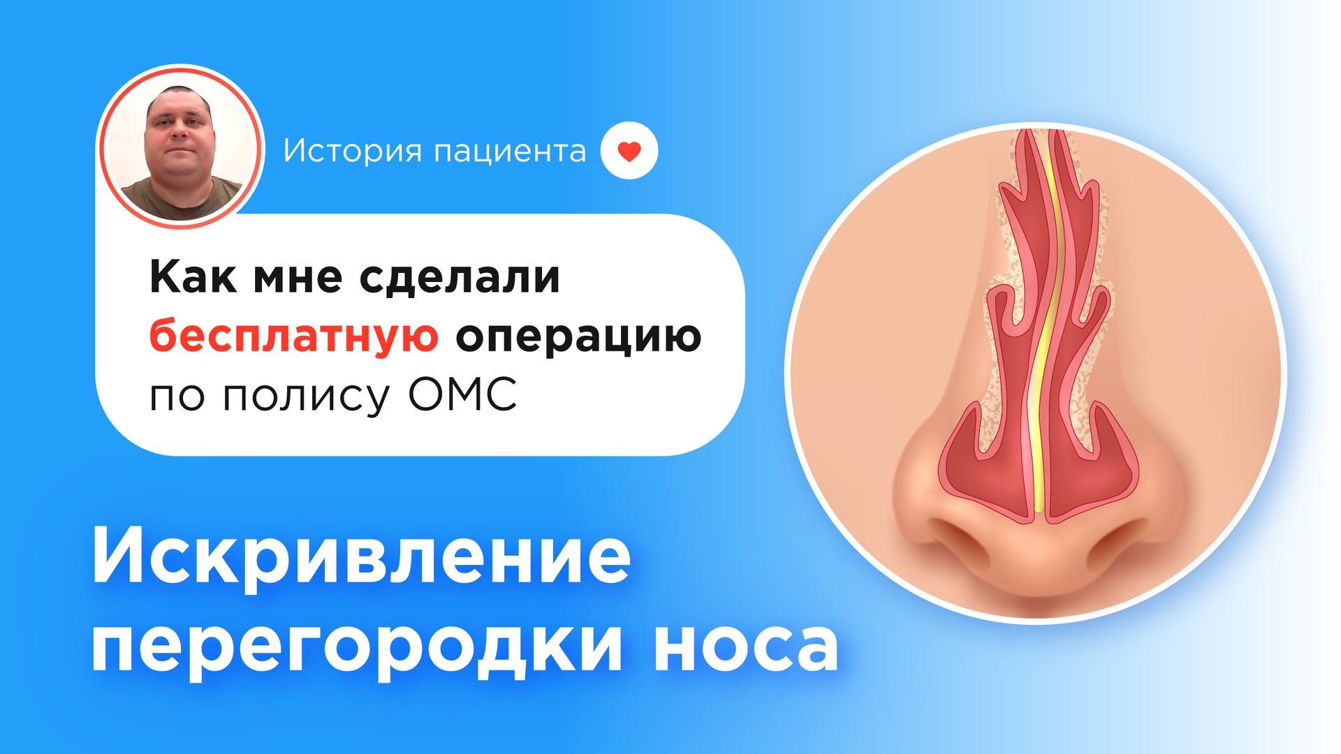 Как я сделал операцию бесплатно по ОМС — септопластика при искривлении перегородки носа