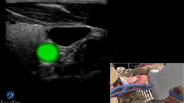 Катареизация яремной вены