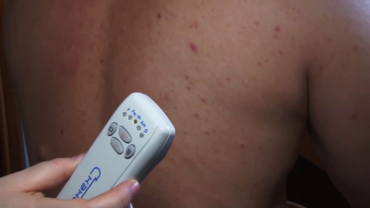 ЧЭНС-01-"Скэнар". Подбор энергии воздействия