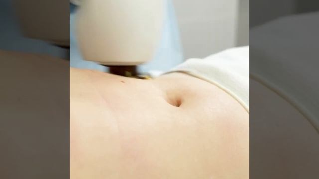 Коррекция объема тела RSL Скульптурирование и Rf-лифтинг на аппарате Accent