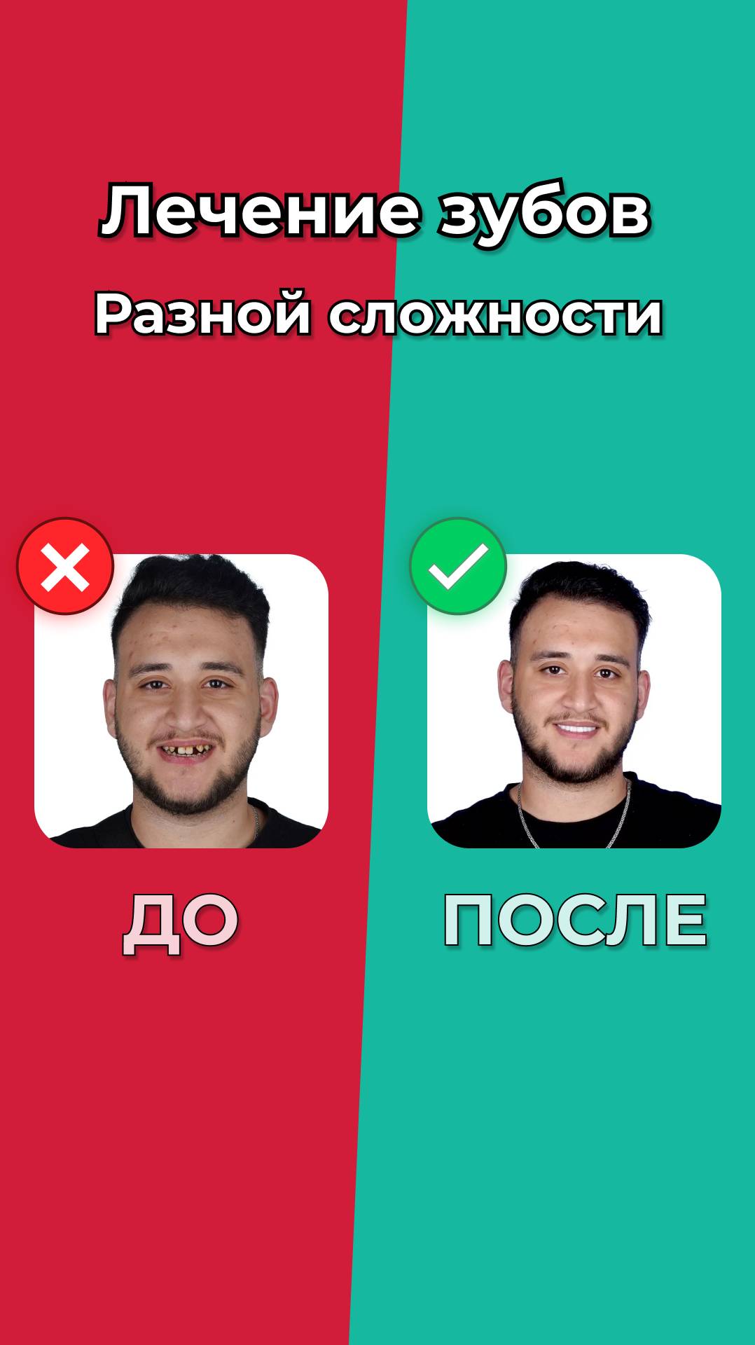 Лечение Зубов разной сложности! | Лечение в Турции