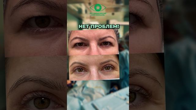 Нависшие веки