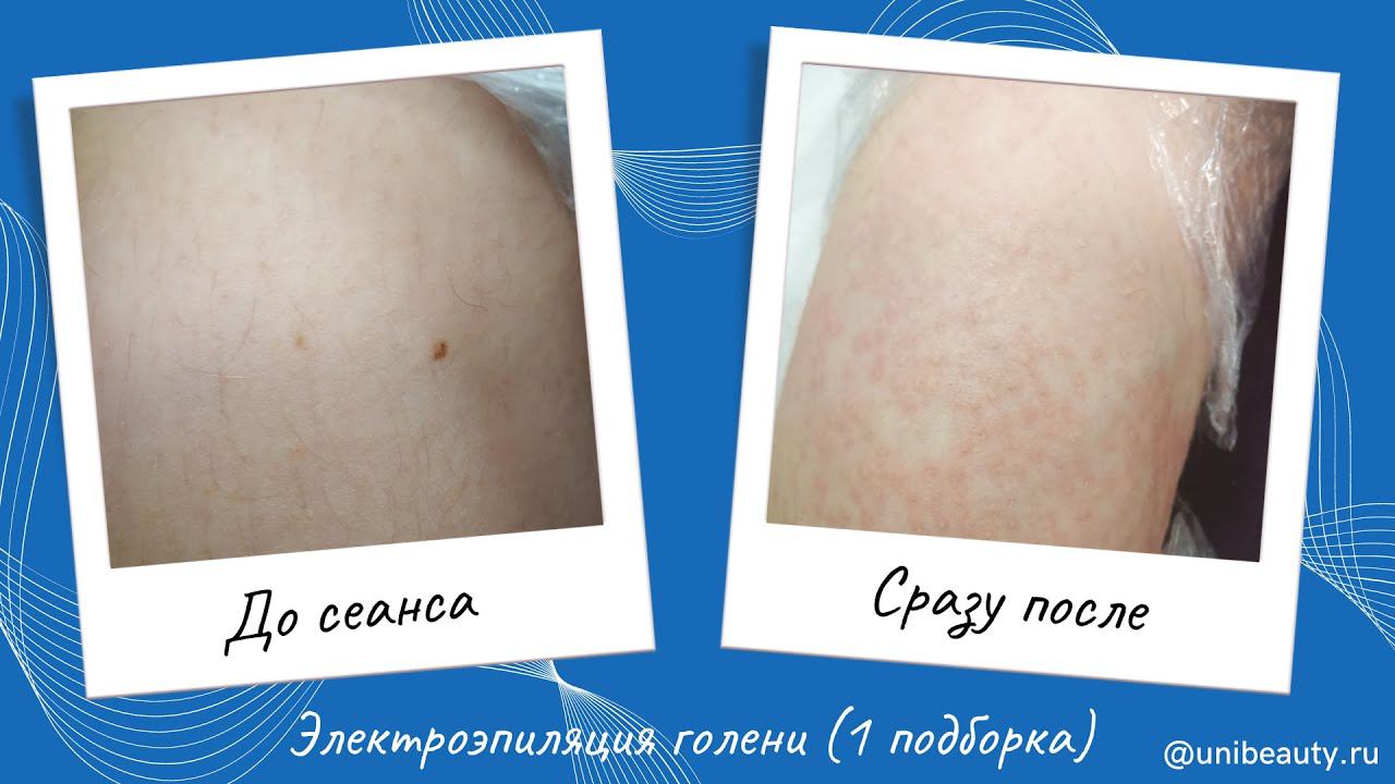 Электроэпиляция голени методом blend