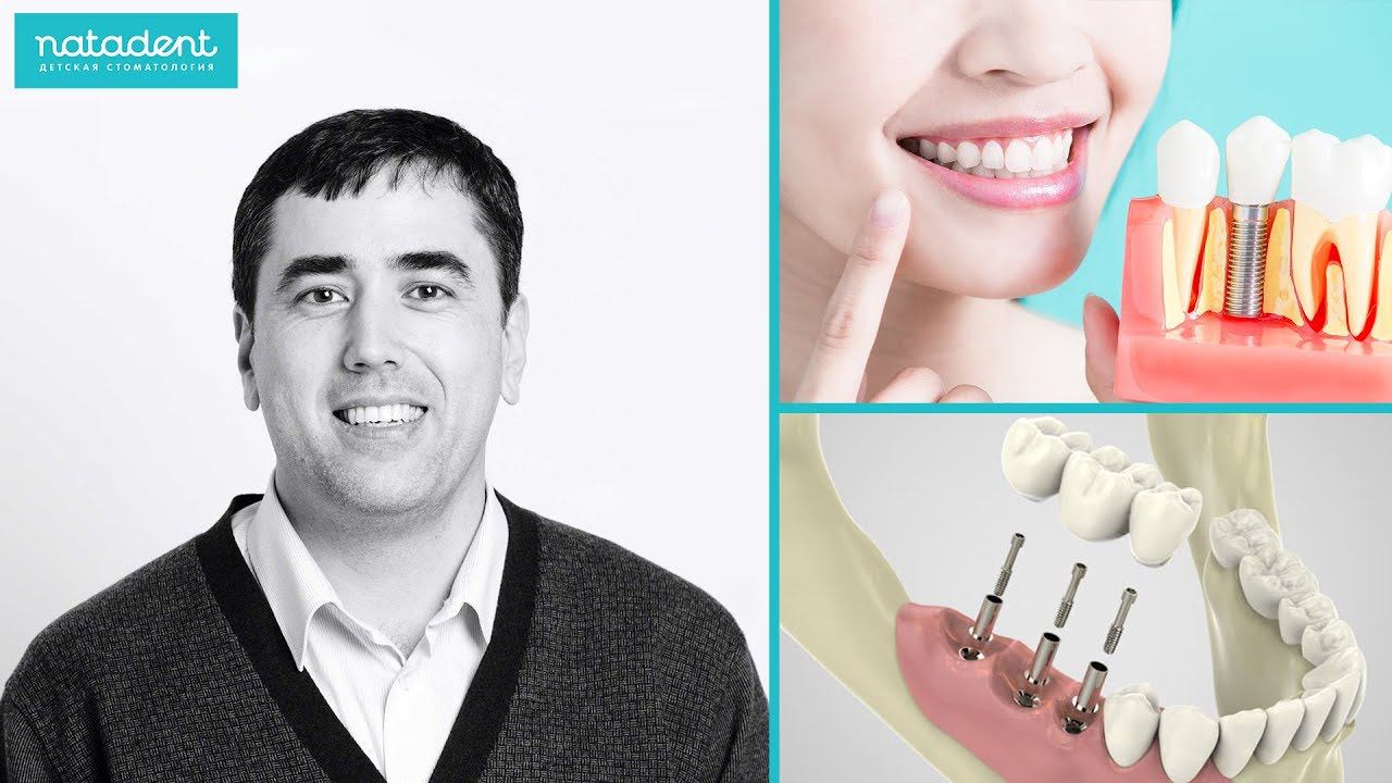 135. Протезирование на имплантатах. Виды. Натадент стоматология