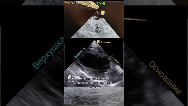 Как ставить датчик, когда делаешь УЗИ или ЭХО | детальное описание в Телеграм