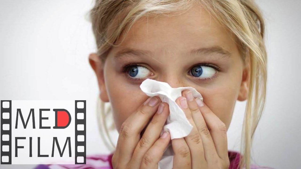 Риносинуситы, респираторные инфекции у детей © Purulent rhinosinusitis