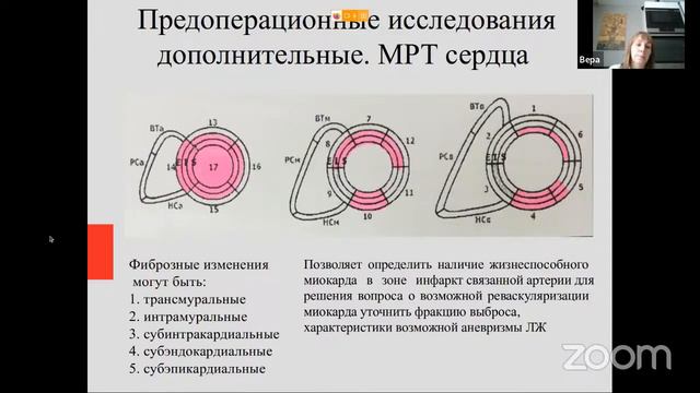 Особенности сердечной ресинхронизирующей терапии. Показания, критерии диагностики