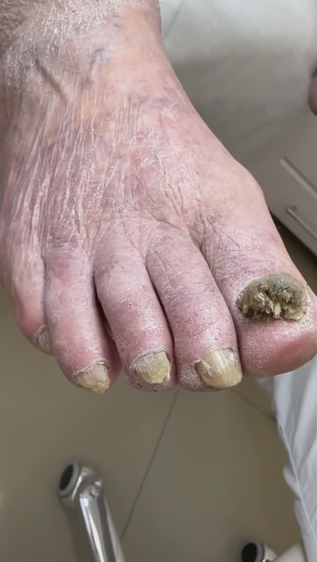 Обработка ногтей при Онихогрифозе. Подолог Симферополь.