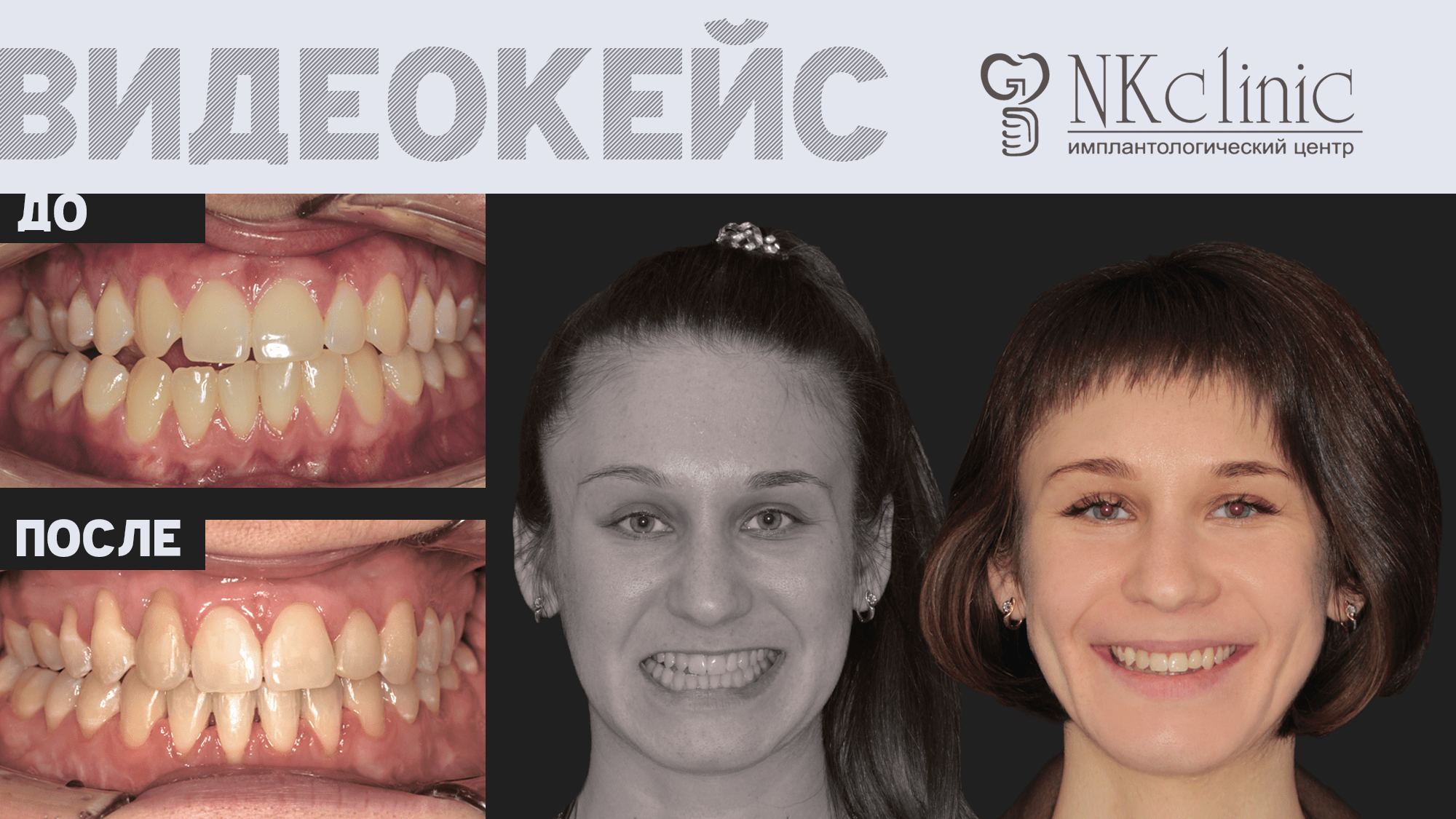 Исправление прикуса и асимметрии лица после перелома челюсти