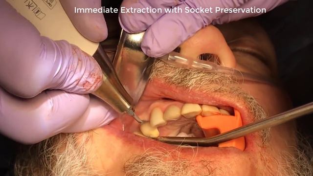 Техника удаления зуба пьезохирургическим аппаратом