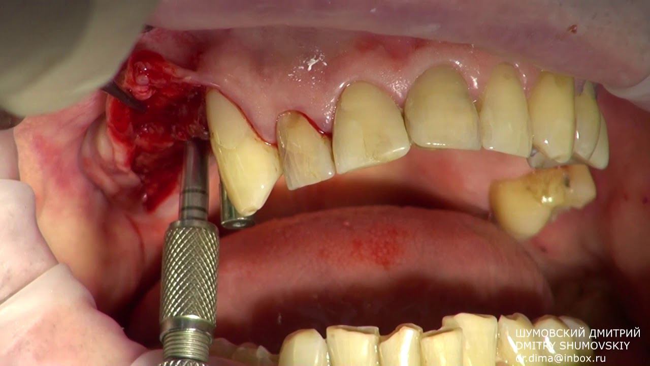 Доктор Шумовский Д.Б. Установка имплантатов DENTIS с помощью хирургического шаблона.