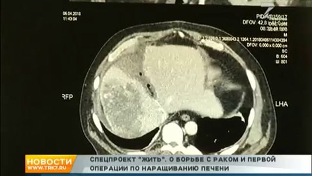 История спасения. Наращивание печени (24.05.2018)