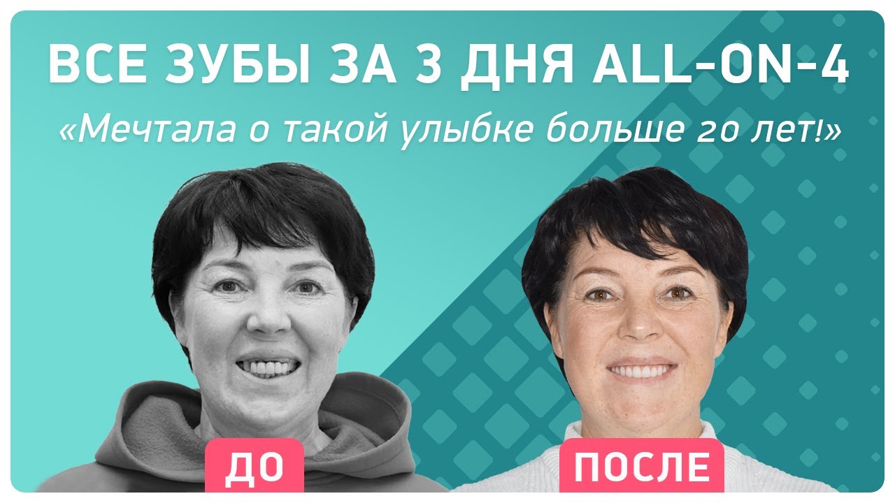Мечта о новой улыбке в 20 лет: все этапы all-on-4 и протезы за 3 дня