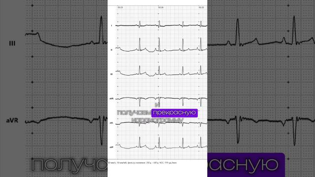 Помехи на ЭКГ и смарт-часы связаны