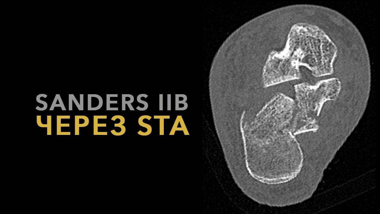 Sanders IIB через STA