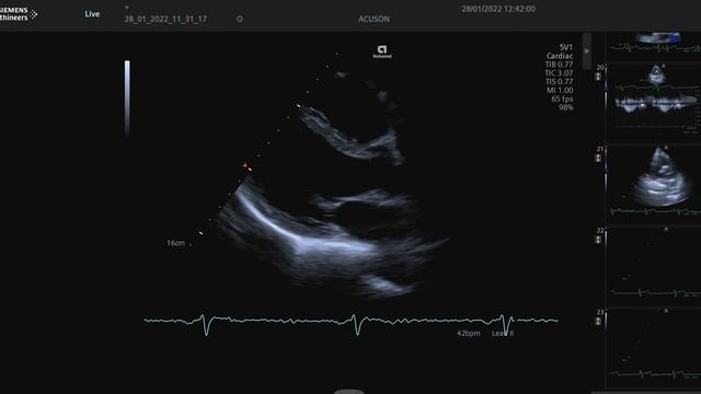 US_ACUSON Redwood.mp4
