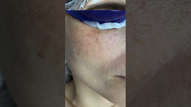 Результат лазерного омоложения лица