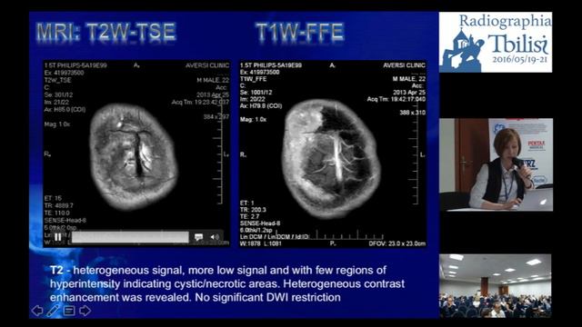 Полиосальная фиброзная дисплазия. Лучевая диагностика