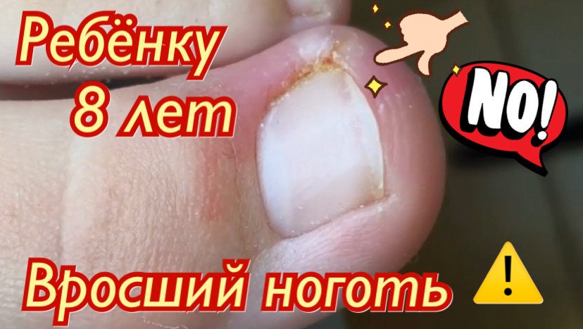 Вросший ноготь?⚠️?? • Ребёнку 8 лет??