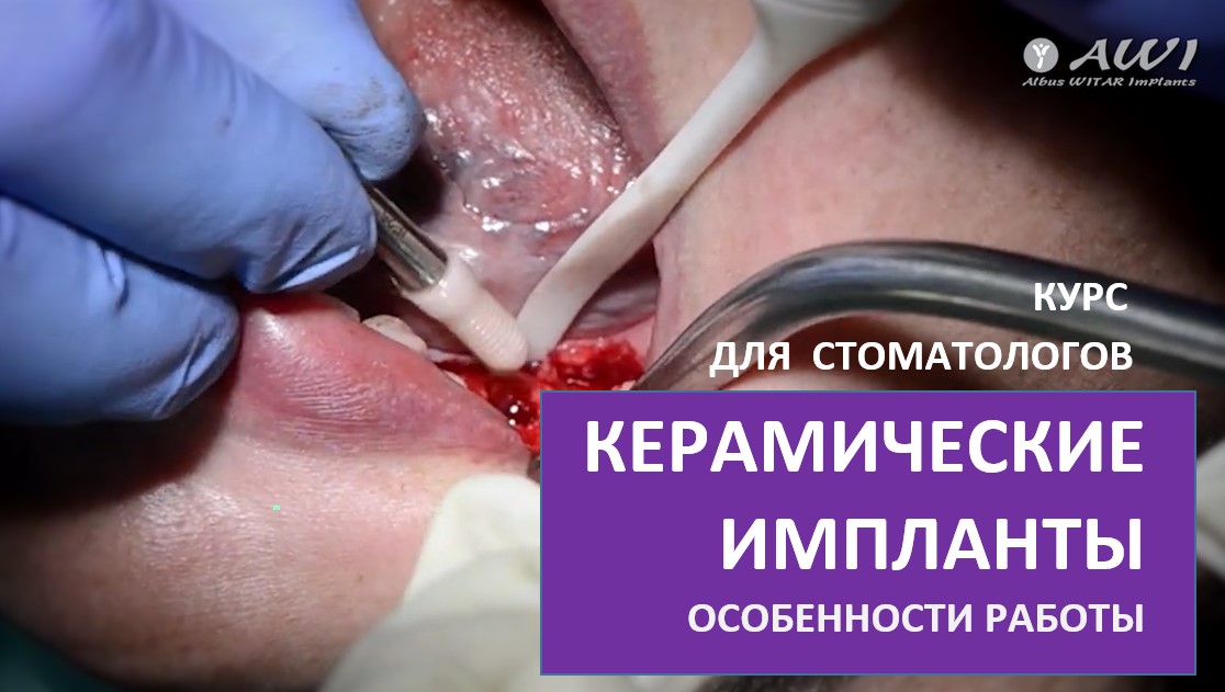 Как устанавливают керамические импланты высокой прочности ➤ Семинар для стоматологов