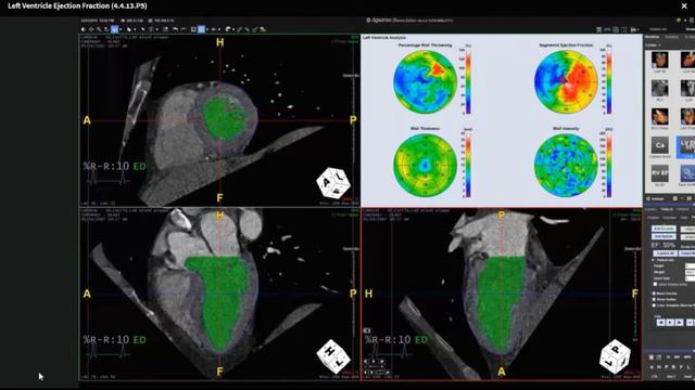 27. Cardiac Left ventricular Analysis