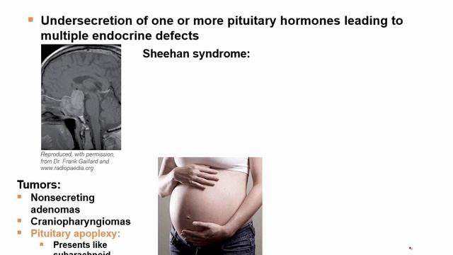 USMLE RX - 3.Эндокринная система - 3.Патология - 16.ГИПОпитуитаризм