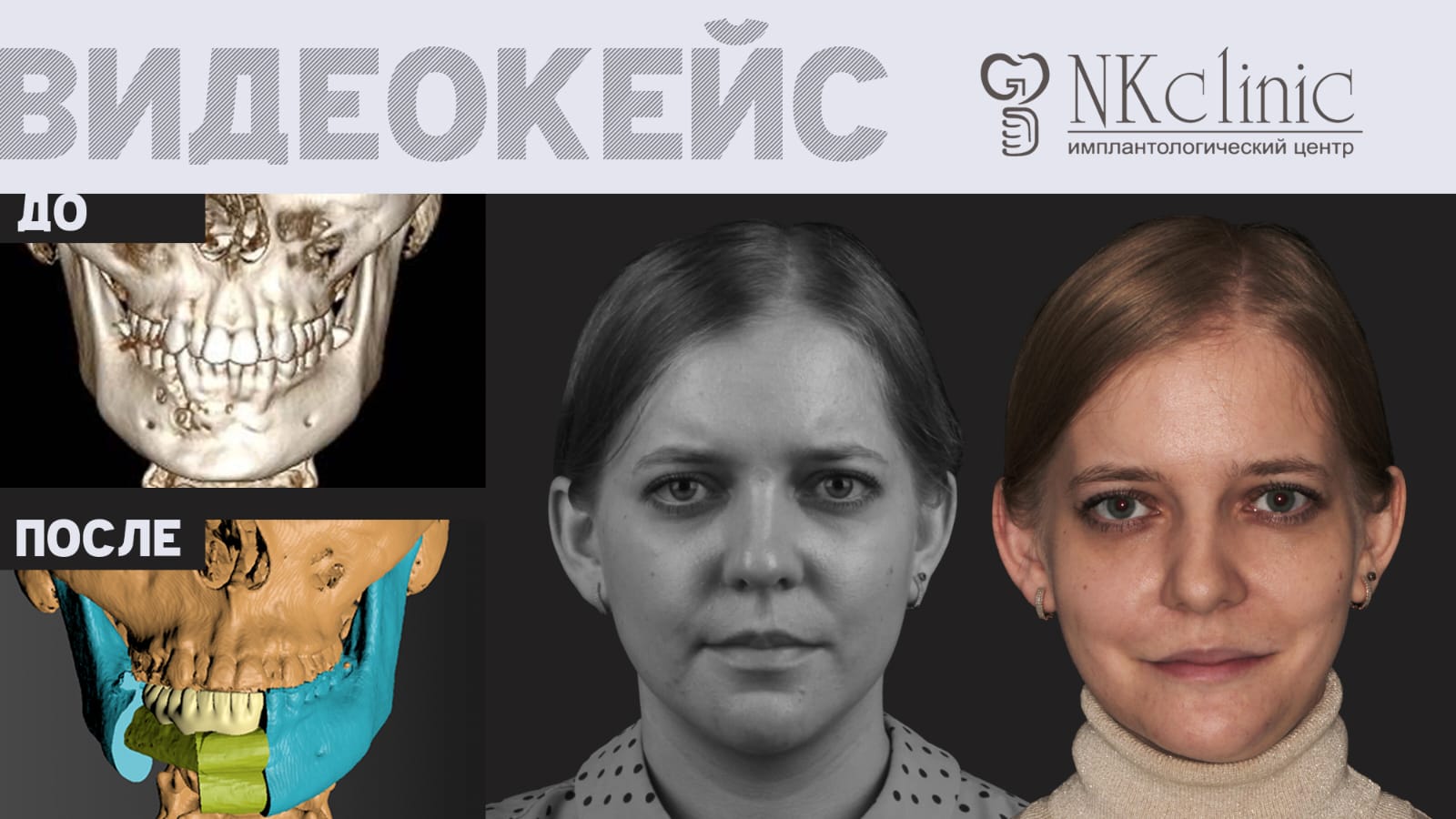 Удаление опухоли (амелобластомы) нижней челюсти