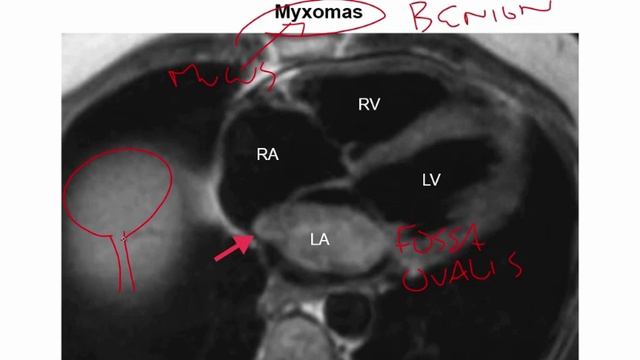 USMLE RX - 2.Кардиология - 3.Патология - 9.Опухоли сердца