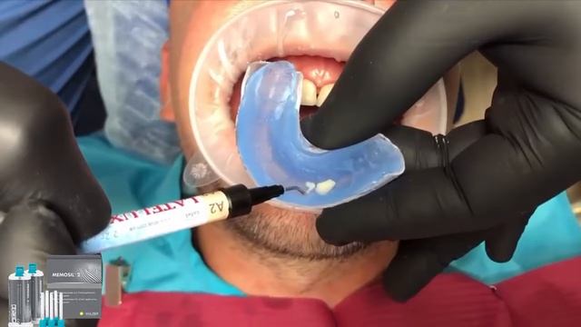 Доктор Алексей Махов - тестирование прозрачного А-силикона Memosil 2