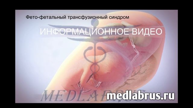 Синдром переливания крови от одного близнеца к другому или фето-фетальный трансфузионный синдром