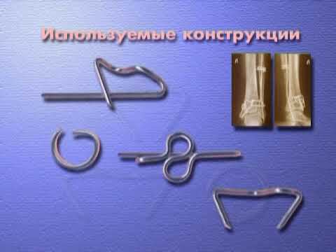 Остеосинтез фиксаторами с памятью формы при повреждениях дистального сегмента костей голени и г. с.