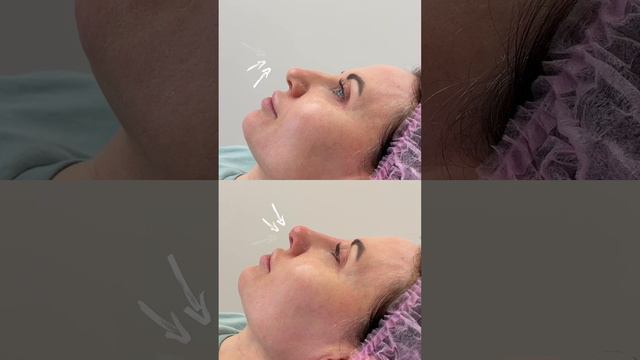 Безоперационная ринопластика #коррекцияноса #безоперационнаяринопластика #носбезоперации