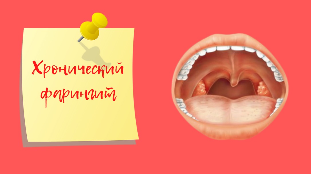 Хронический фарингит | Как избавиться от проблемы навсегда