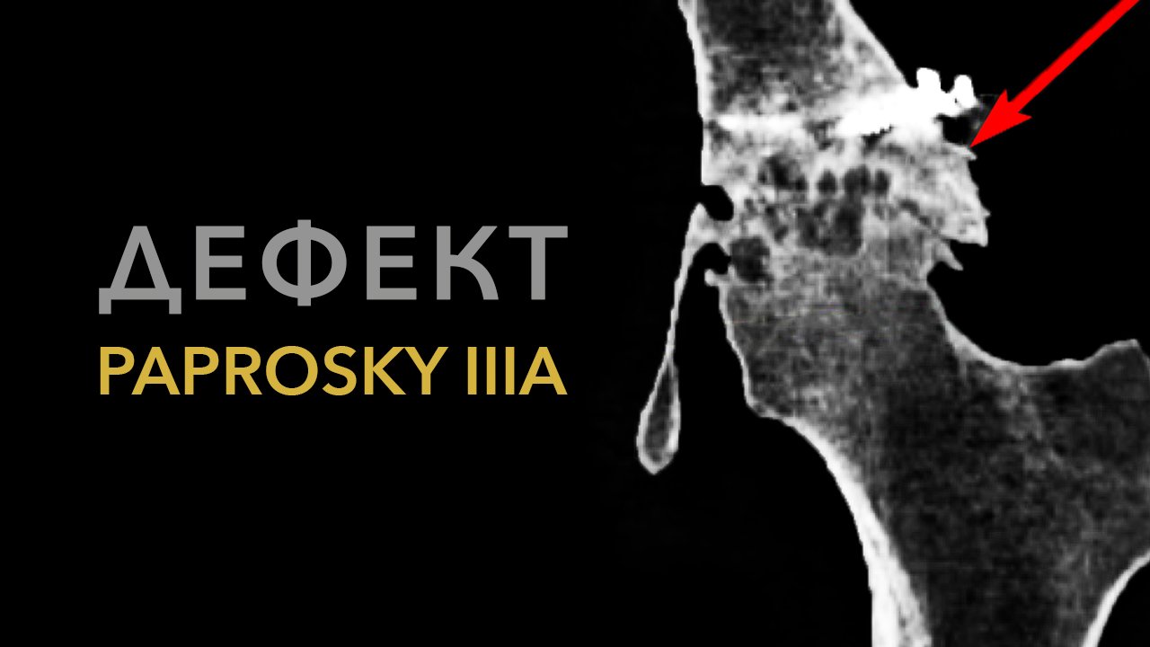 Дефект PAPROSKY III A