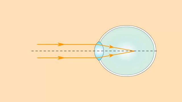 Коррекция близорукости