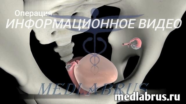 Лечение рака шейки матки