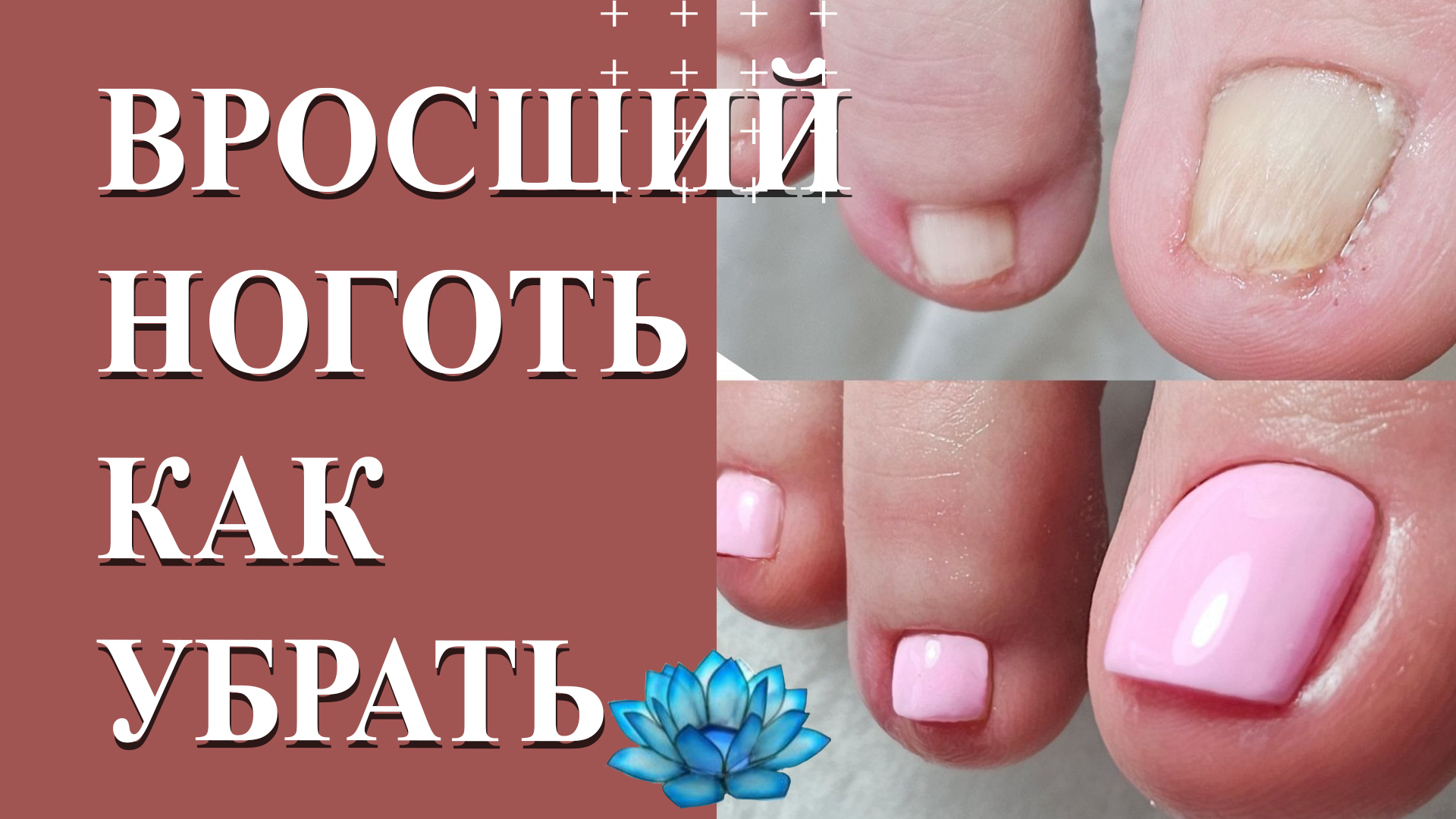 Вросший ноготь на большом пальце. Вырвнивание ногтей.