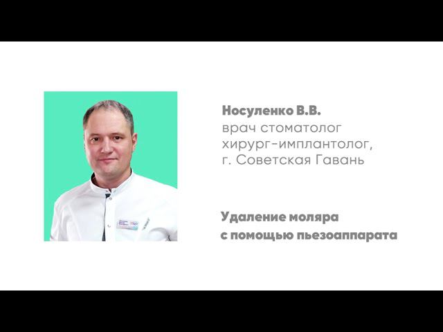 Удаление моляра при помощи пьезоаппарата Sonic Surgeon 600L.