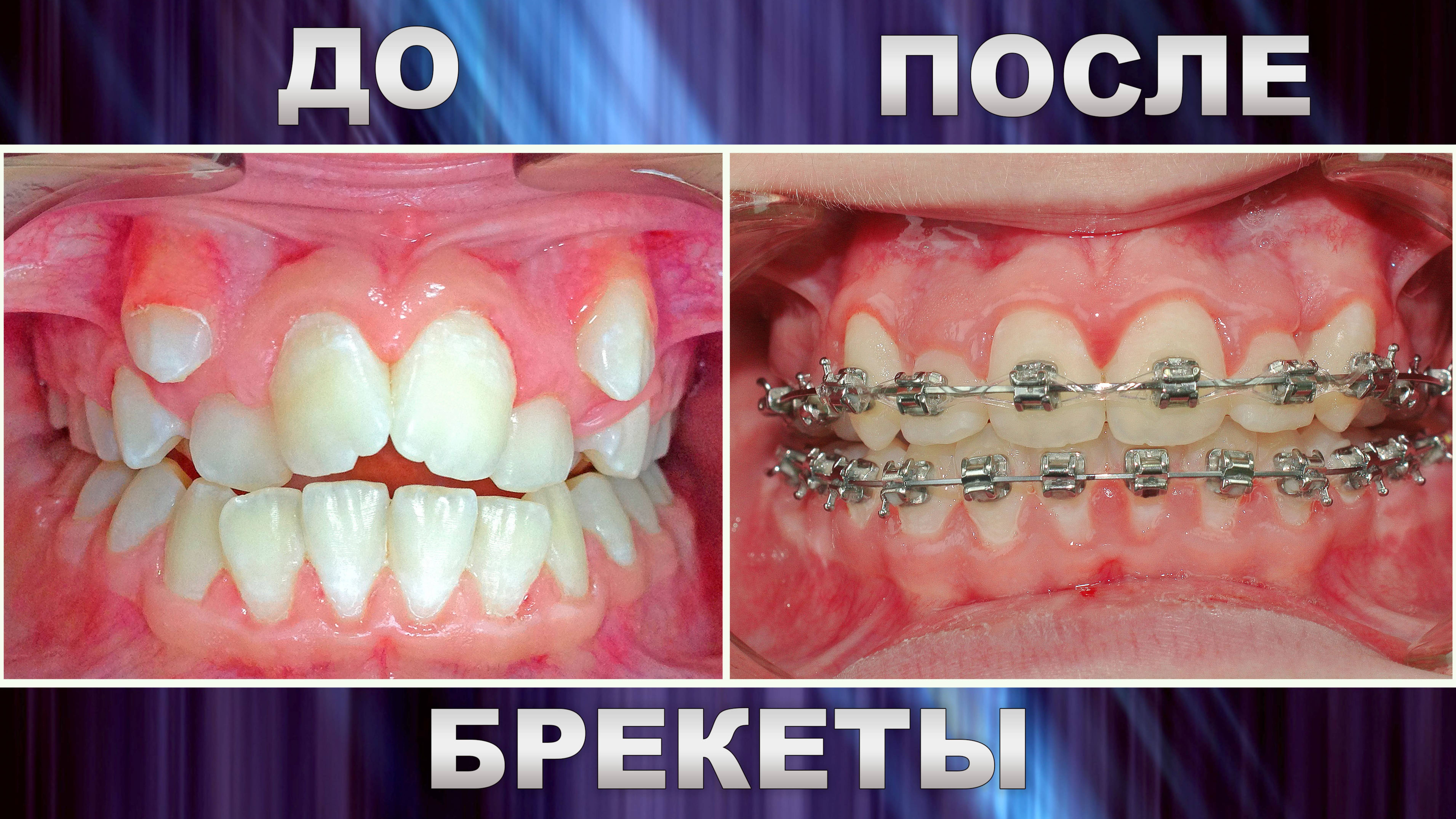 Исправление прикуса ДО/ПОСЛЕ ортодонтического лечения