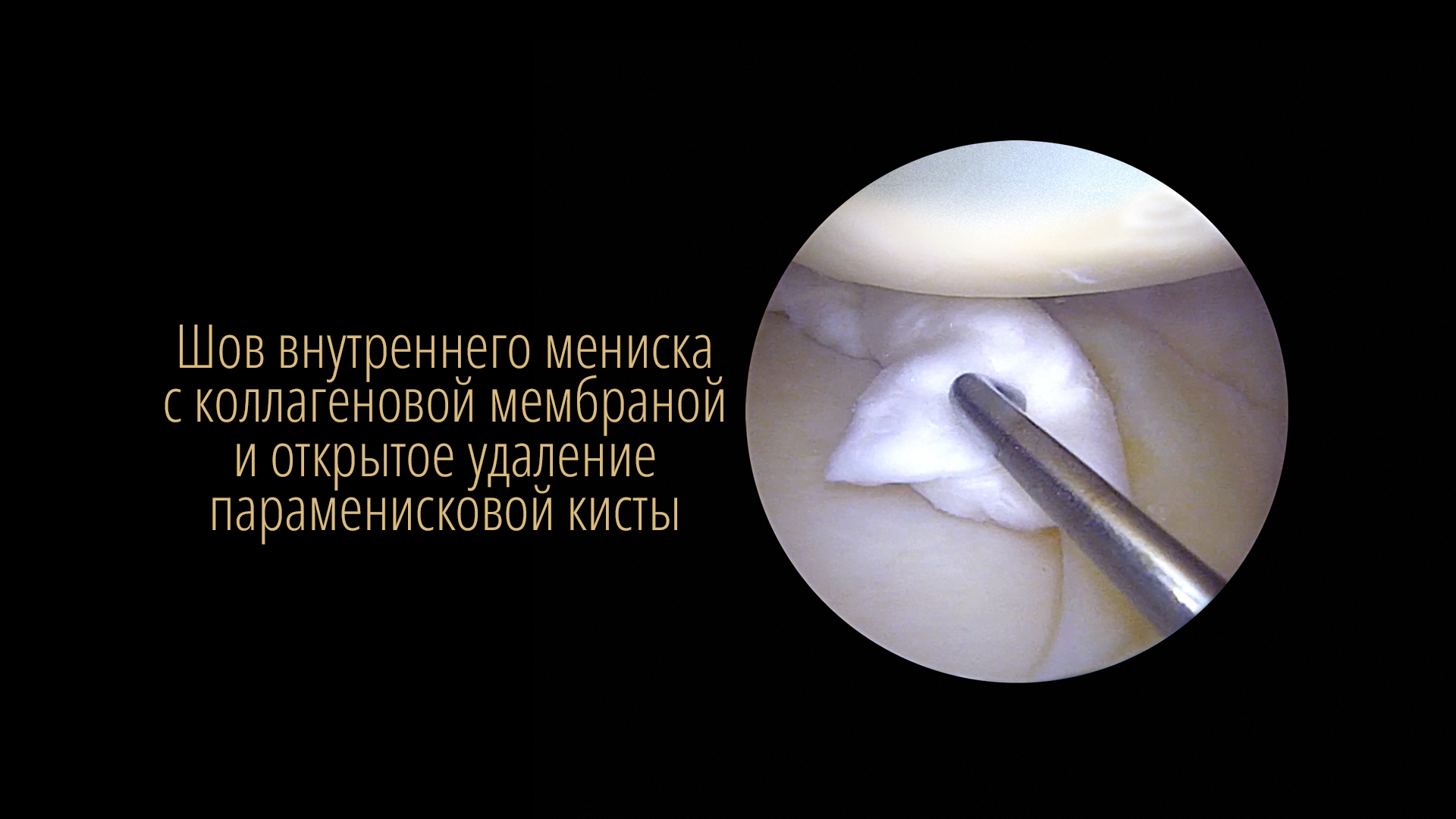 Шов внутреннего мениска с коллагеновой мембраной и открытое удаление параменисковой кисты