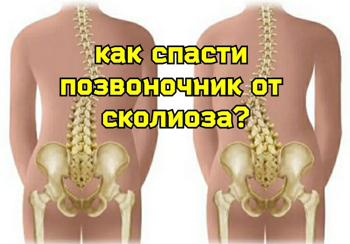Поясничный сколиоз вредит сердцу и мозгу, разрушает печень и кишечник. Какие нужны упражнения?
