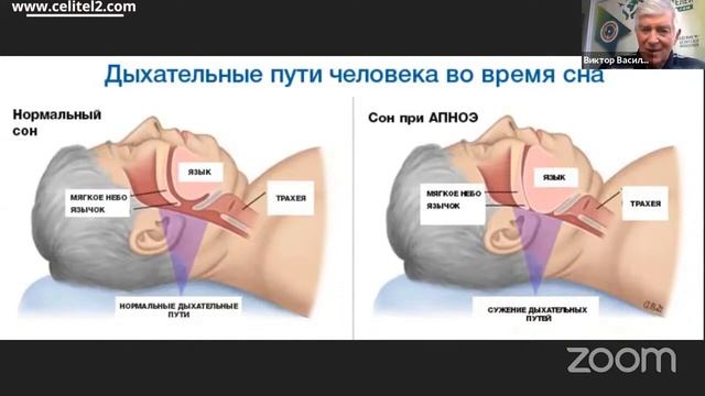Как избавиться от АПНОЭ Причины остановки дыхания во время сна. Руденко В.В. Академия Целителей.mp4