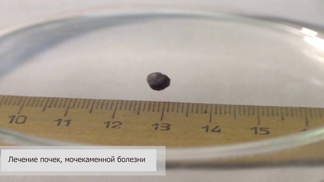Камни в почках Лечение Ундоры. Отзыв
