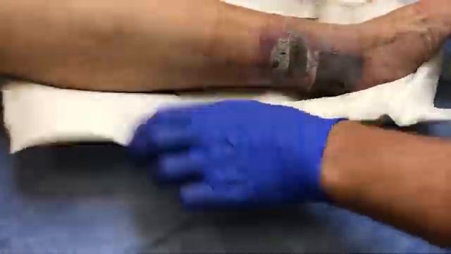 ?️ Вароласт. Лечение венозной язвы.mp4