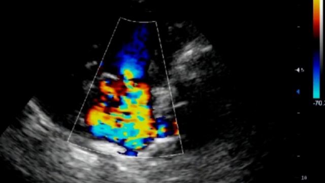 Аускультация собаки. Систолический шум. Митральная регургитация. Слушать в наушниках.