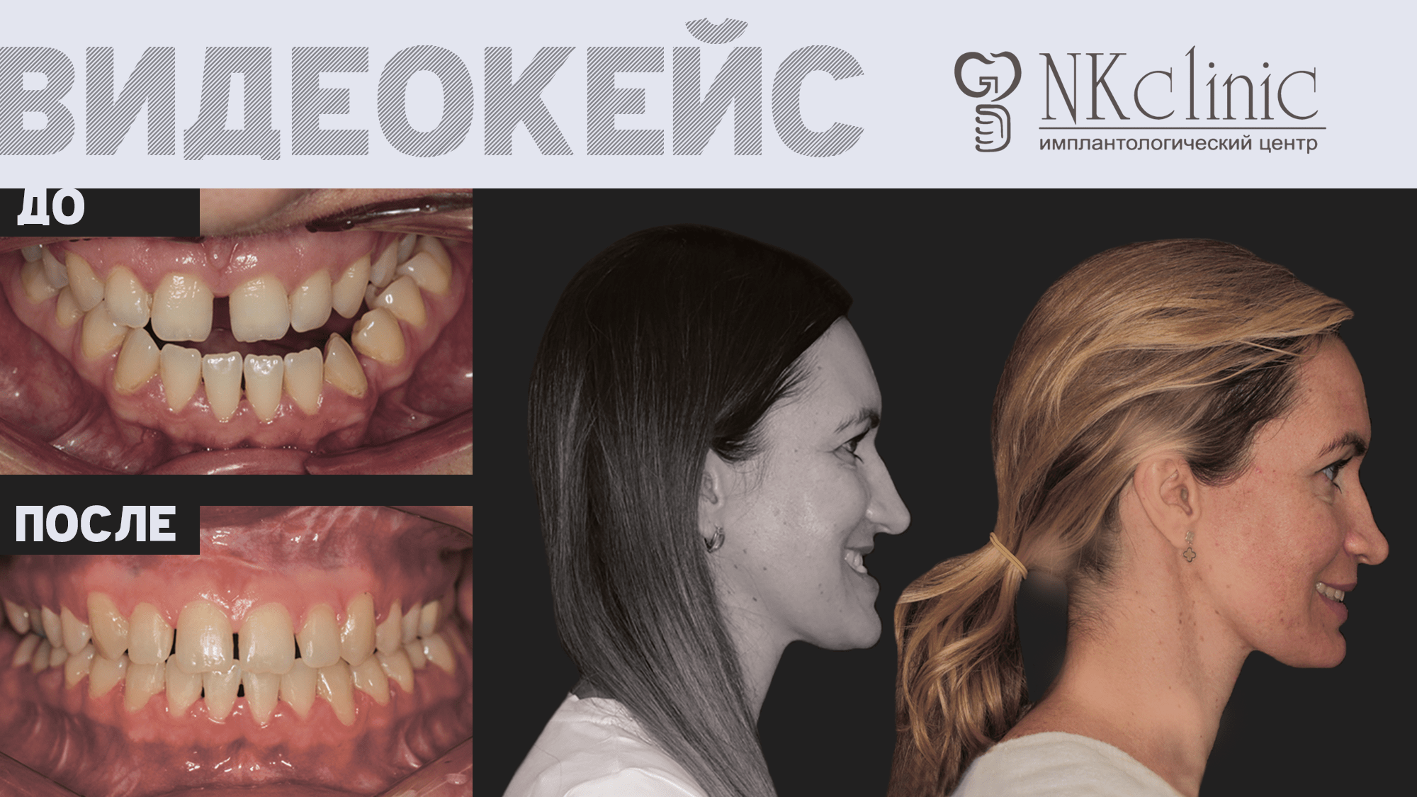 Перекрестный мезиальный прикус и асимметрия лица